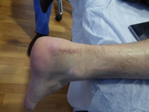 Tratamiento Enfermedad Deformidad de Haglund con Cirugía Ecoguiada