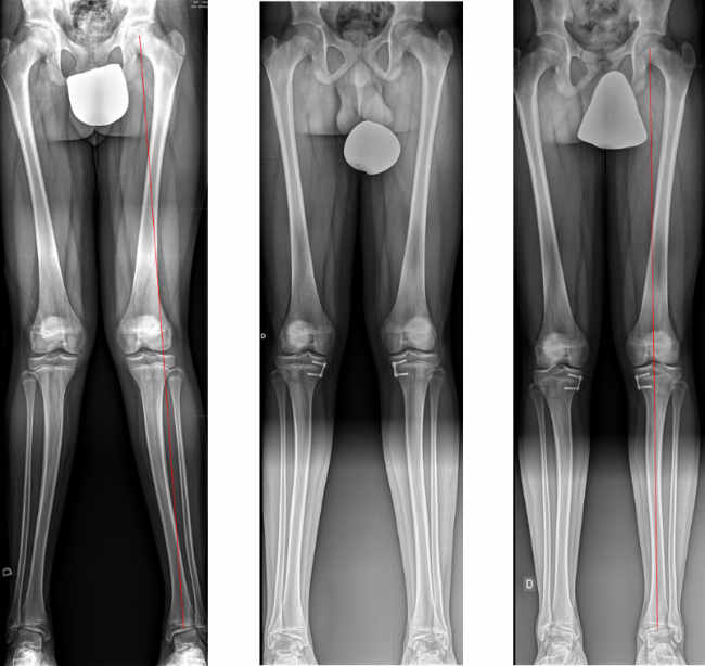 Cirugía de Crecimiento Guiado en Extremidades Inferiores | Avanfi