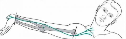Fisioterapia Con Neurodinamia Avanfi