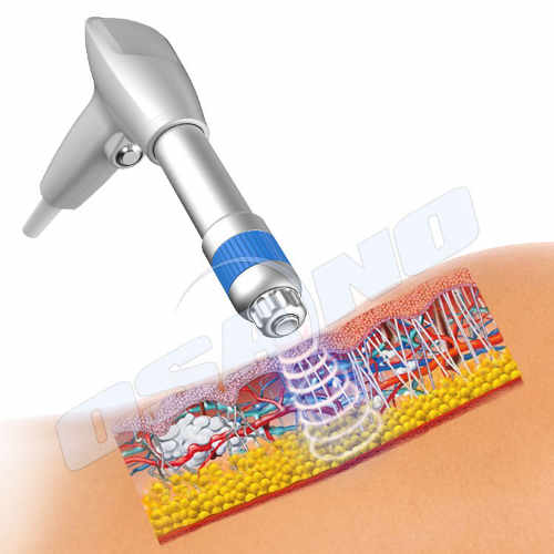 Fisioterapia con Ondas de Choque | Avanfi Fisioterapia con Ondas de Choque | Avanfi