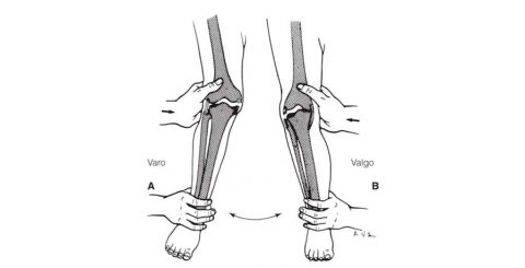 Fisioterapia para la Epicondilitis » Avanfi