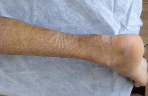 Paratendinosis del Tendón de Aquiles con Cirugía Ecoguiada, sin abrir